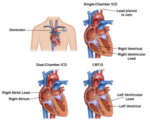 ICDs – LMNA Cardiac