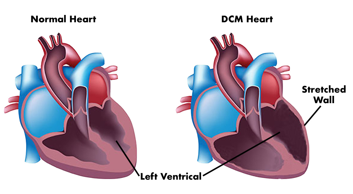 Prognosis - LMNA Cardiac